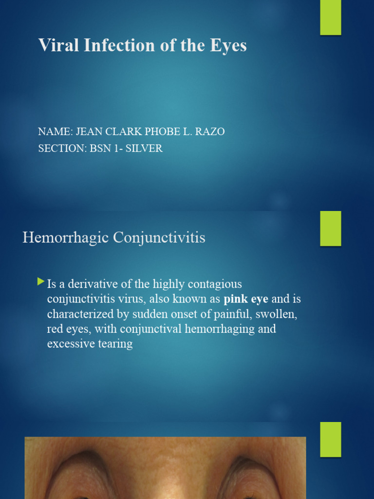 Viral Infection of The Eyes: Name: Jean Clark Phobe L. Razo Section ...
