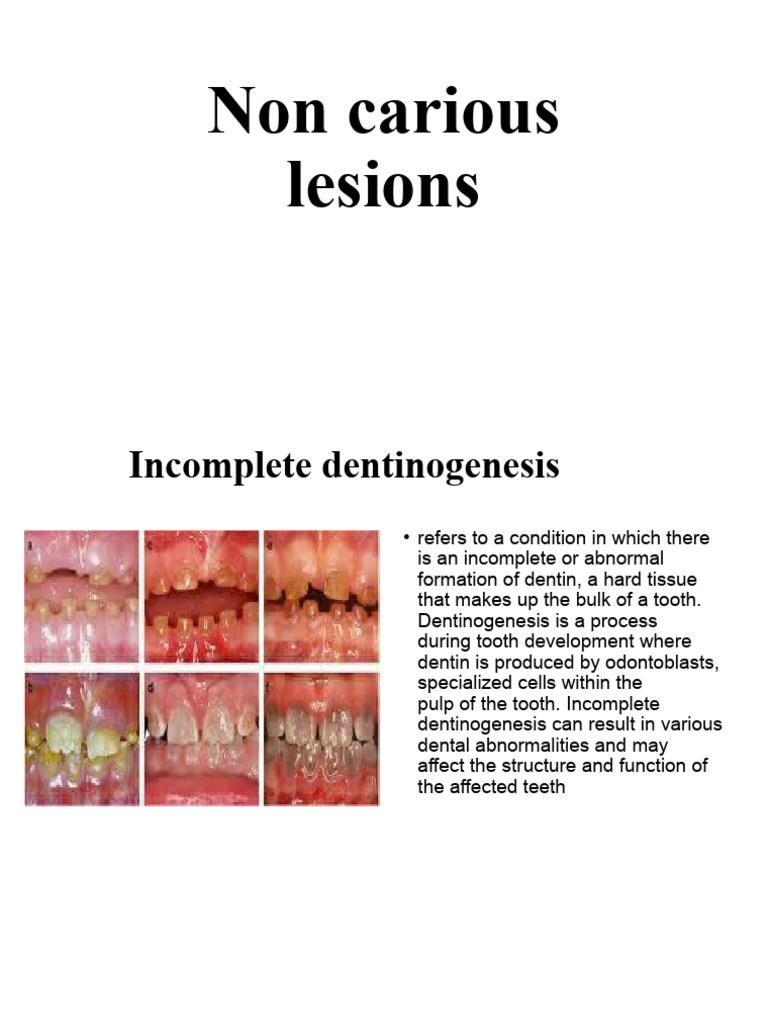 Non Carious Lesions 2 | PDF