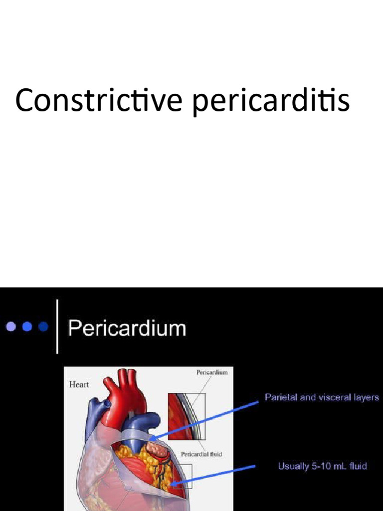 Constrictive Pericarditis | PDF