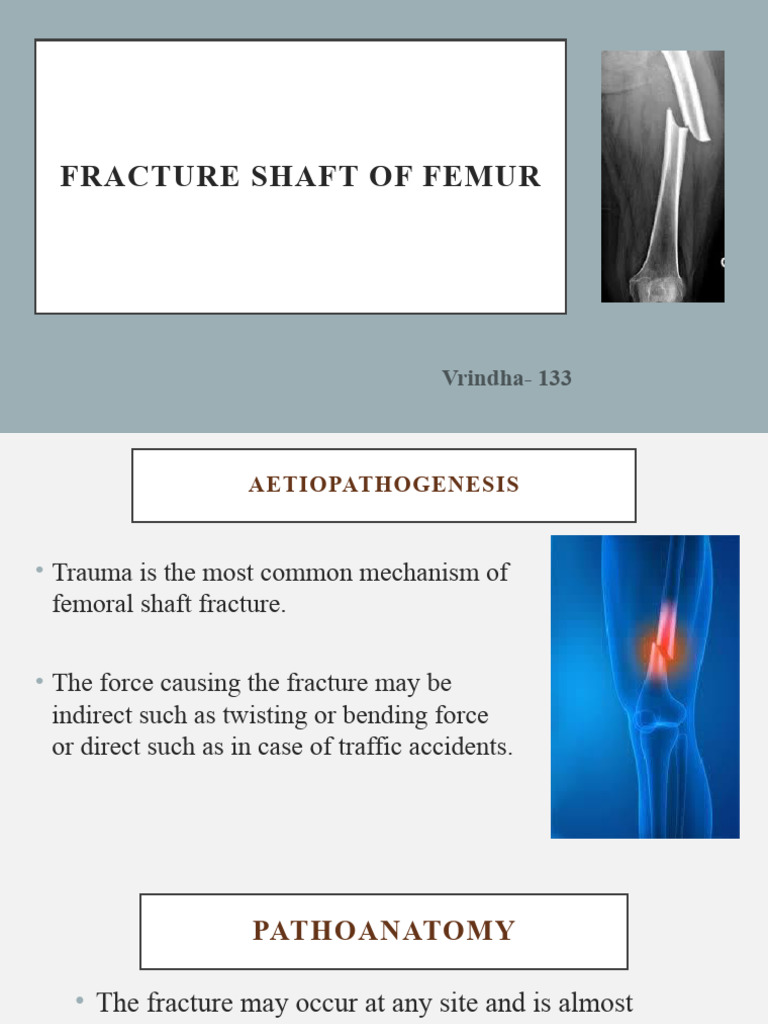 Femoral Shaft Fracture Overview and Treatment | PDF