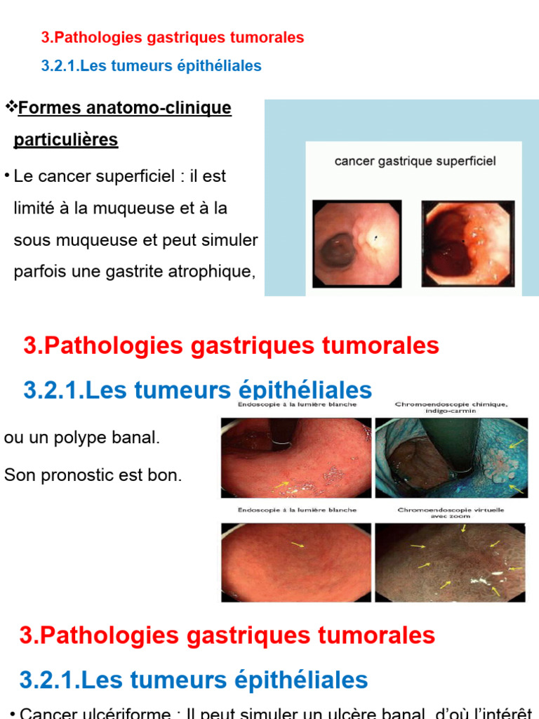 Anapath Special | PDF | Cancer du côlon | Estomac