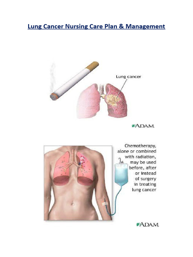 Lung Cancer Nursing Care Plan & Management | PDF | Lung Cancer | Cancer