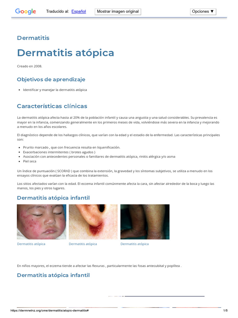 Dermatitis. Dermatitis Atópica - DermNet | PDF | Dermatitis | Epidemiología
