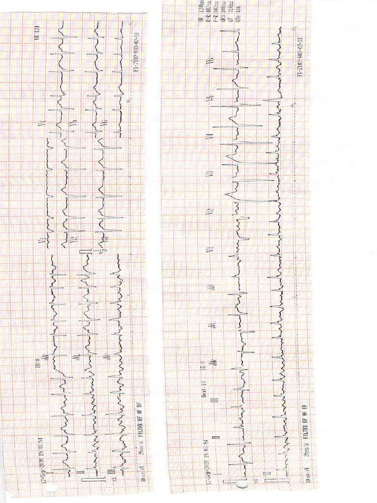 Ecg Af | PDF