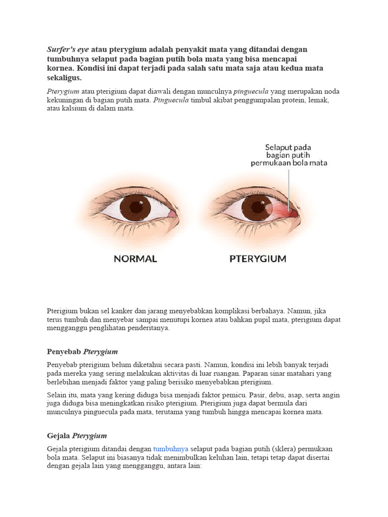 Pterygium: Gejala, Penyebab, dan Pengobatan | PDF