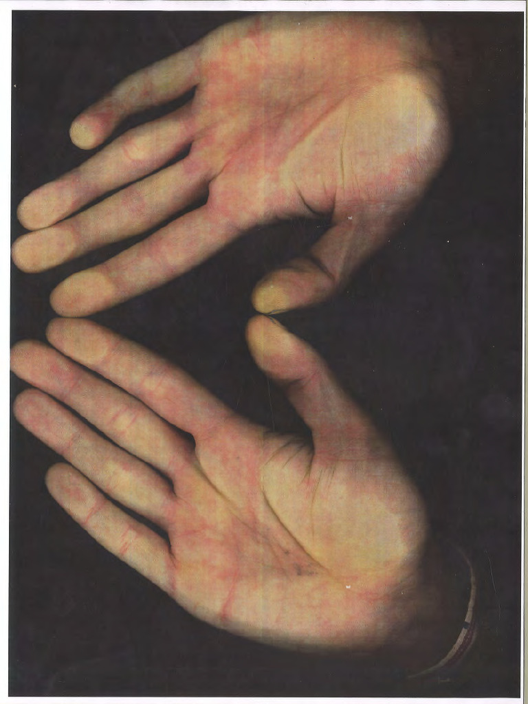 Scan Ruke Plus Krivi PRST | PDF