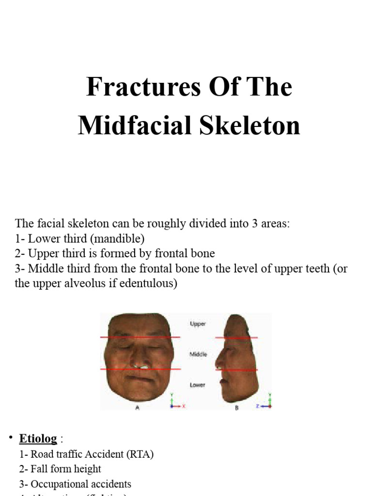 3 (Fractures of The Middle Third) | PDF | Human Nose | Skull