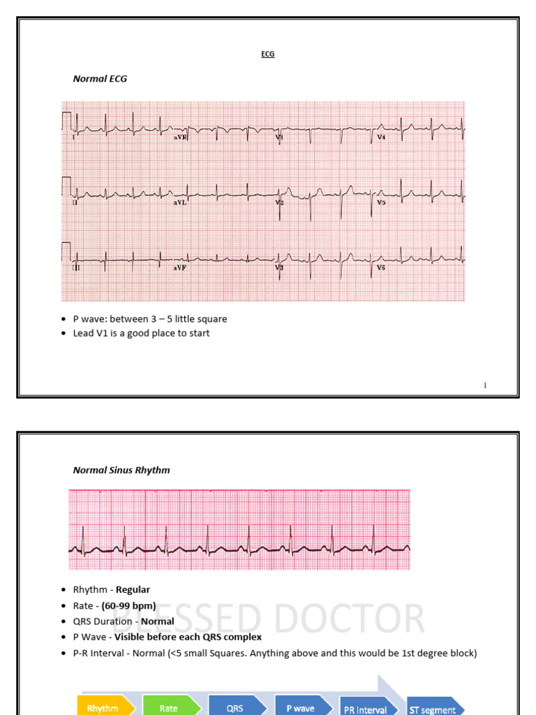 Normal ECG: - P Wave: Between 3 - 5 Little Square - Lead V1 Is A Good Place To Start | PDF ...