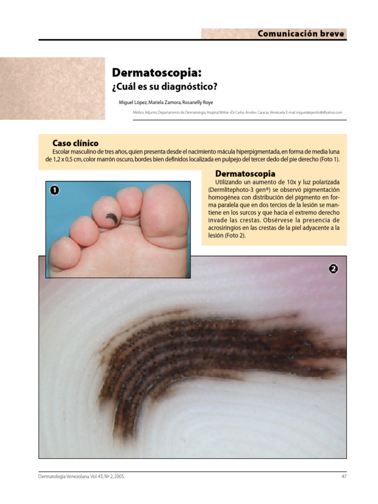 Dermatoscopia Dactilos | PDF | Piel | Condiciones cutáneas