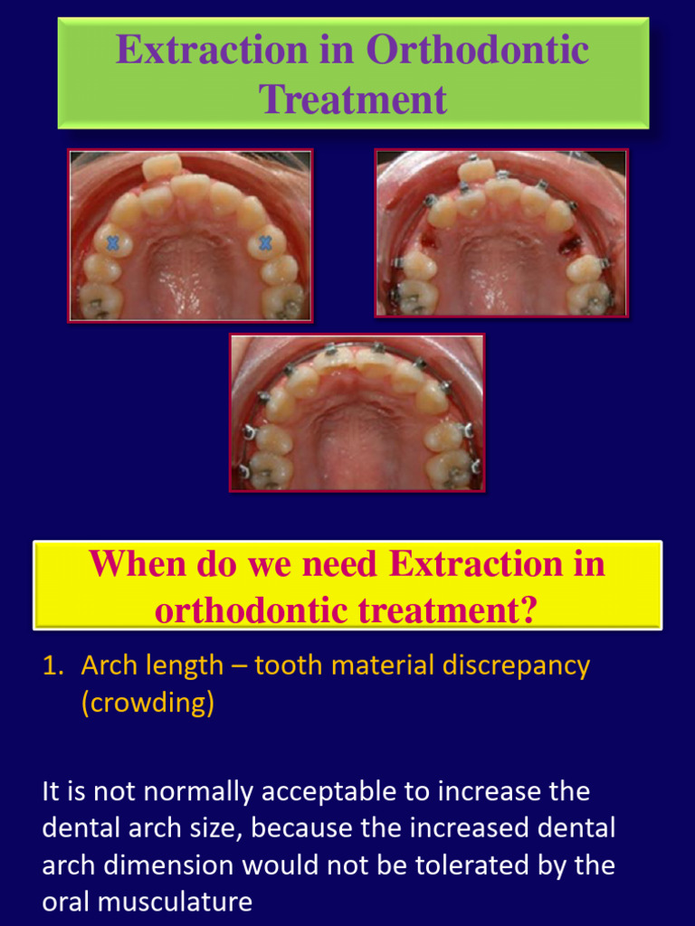 Extraction in Orthodontic Treatment | PDF | Orthodontics | Tooth