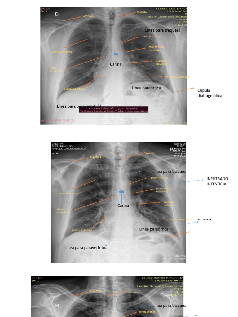 Presentación RX TORAX | PDF | Abdomen | Estómago
