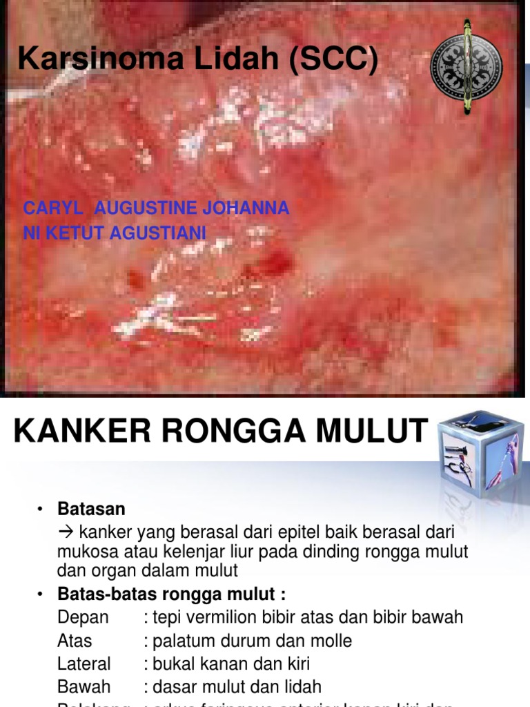 Karsinoma Sel Skuamosa Lidah | PDF
