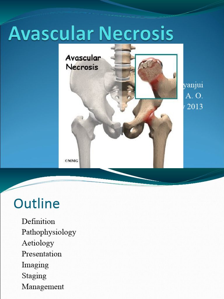 Avascular Necrosis | PDF | Musculoskeletal System | Causes Of Death