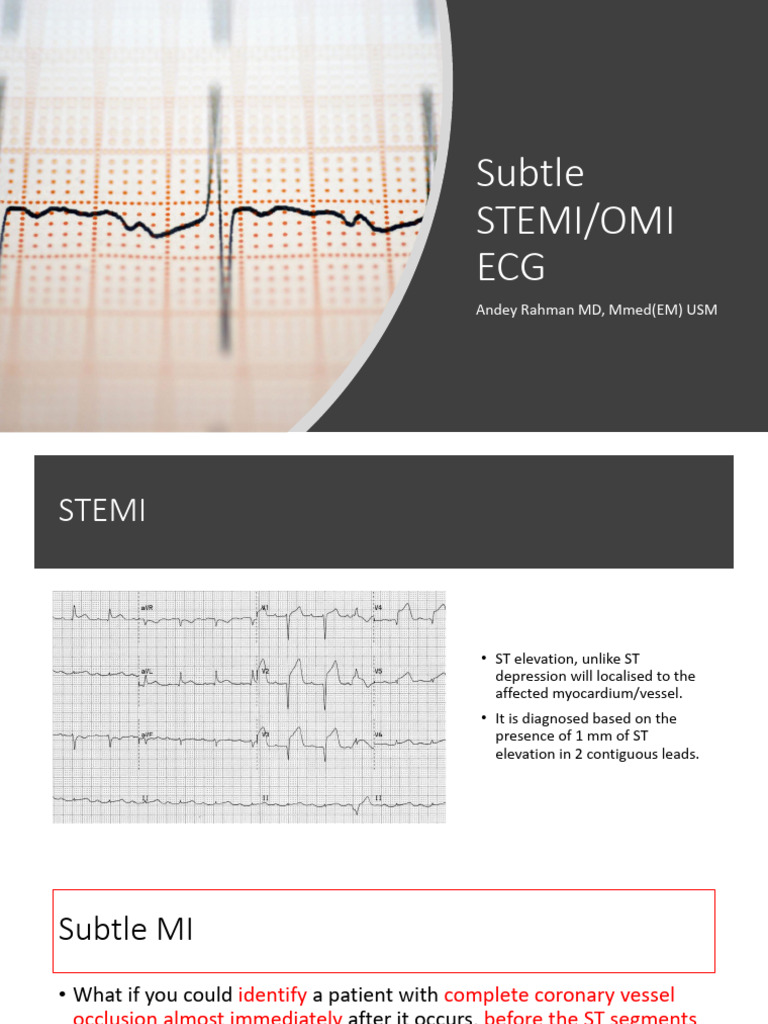 4-Subtle ECG in ACS | PDF | Electrocardiography | Myocardial Infarction