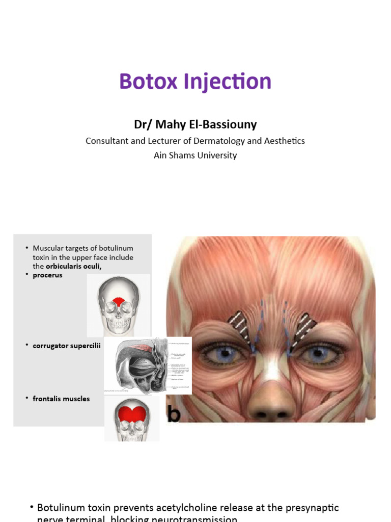 Botox Injection Training | PDF | Botulinum Toxin | Clinical Medicine