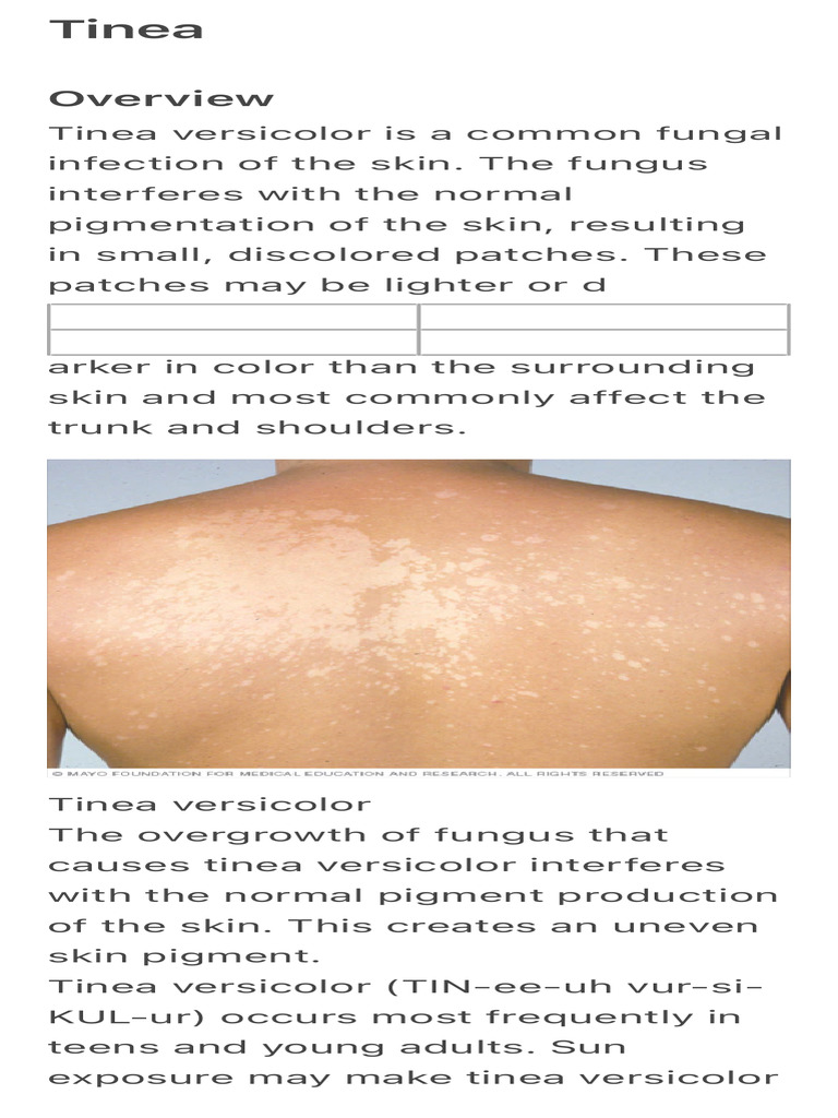 Tinea 488447884322 | Download Free PDF | Immunology | Diseases And ...