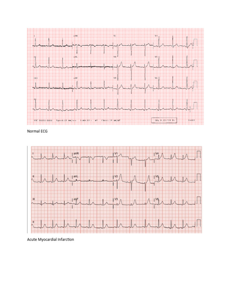 Normal ECG | PDF