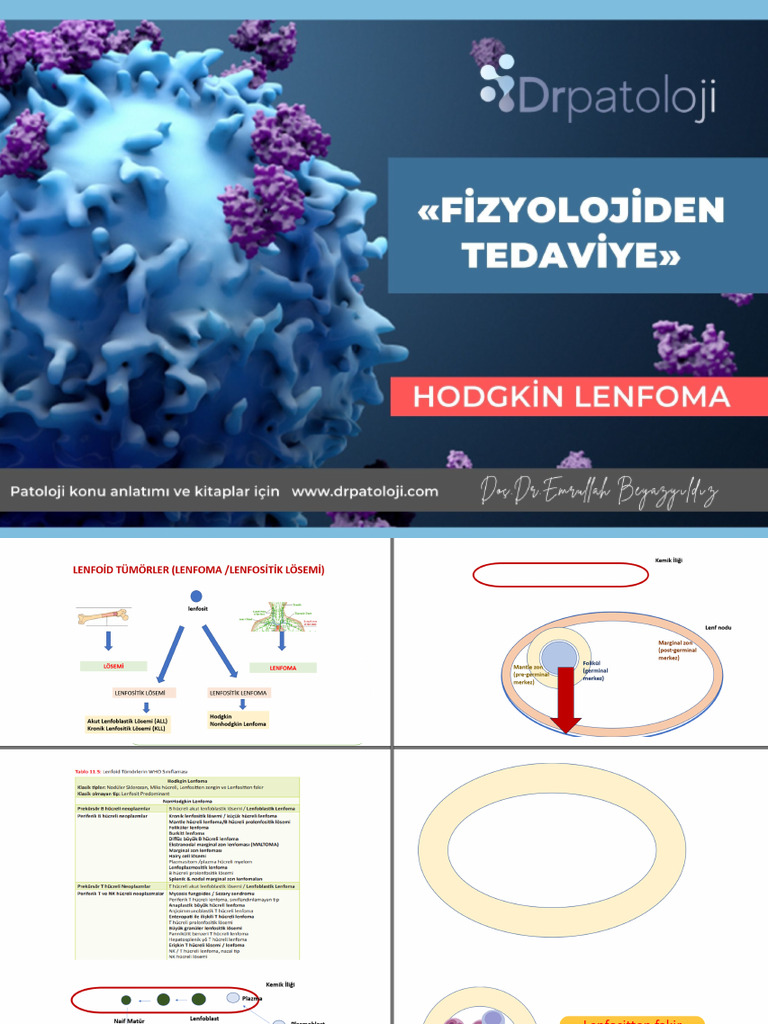 Hodgkin Lenfoma | PDF