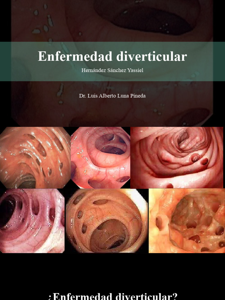 Enfermedad Diverticular | PDF | Causas de la muerte | Enfermedades y trastornos