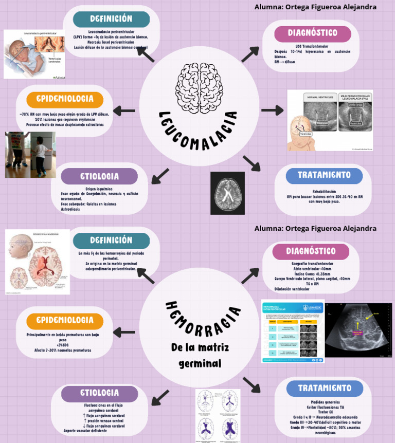 Leucomalacia y Hemorragia de La Matriz Germinal. AOF | PDF ...