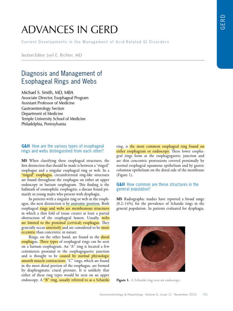 Diagnosis and Management of Esophageal Rings and Webs | PDF | Esophagus ...