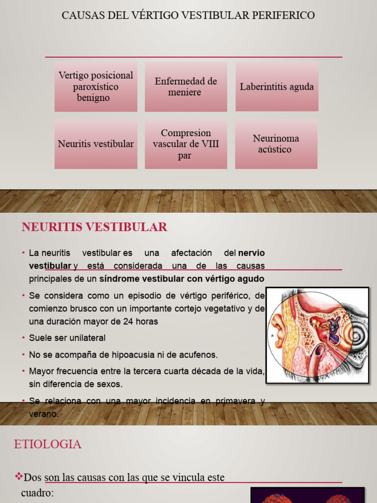 Neuritis Vestibular | PDF | Vértigo | Medicina