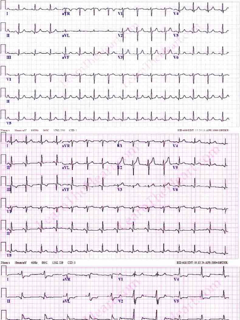 Inferior Wall Mi | PDF