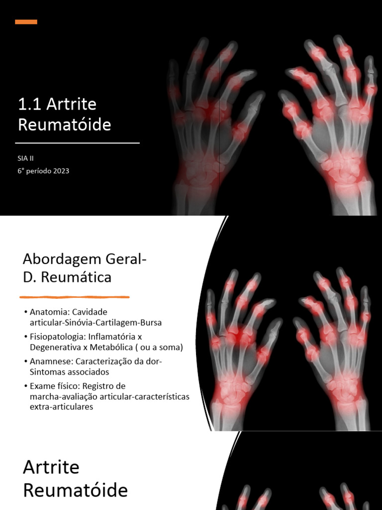 Abordagem da Artrite Reumatoide | PDF | Artrite | Artrite reumatoide