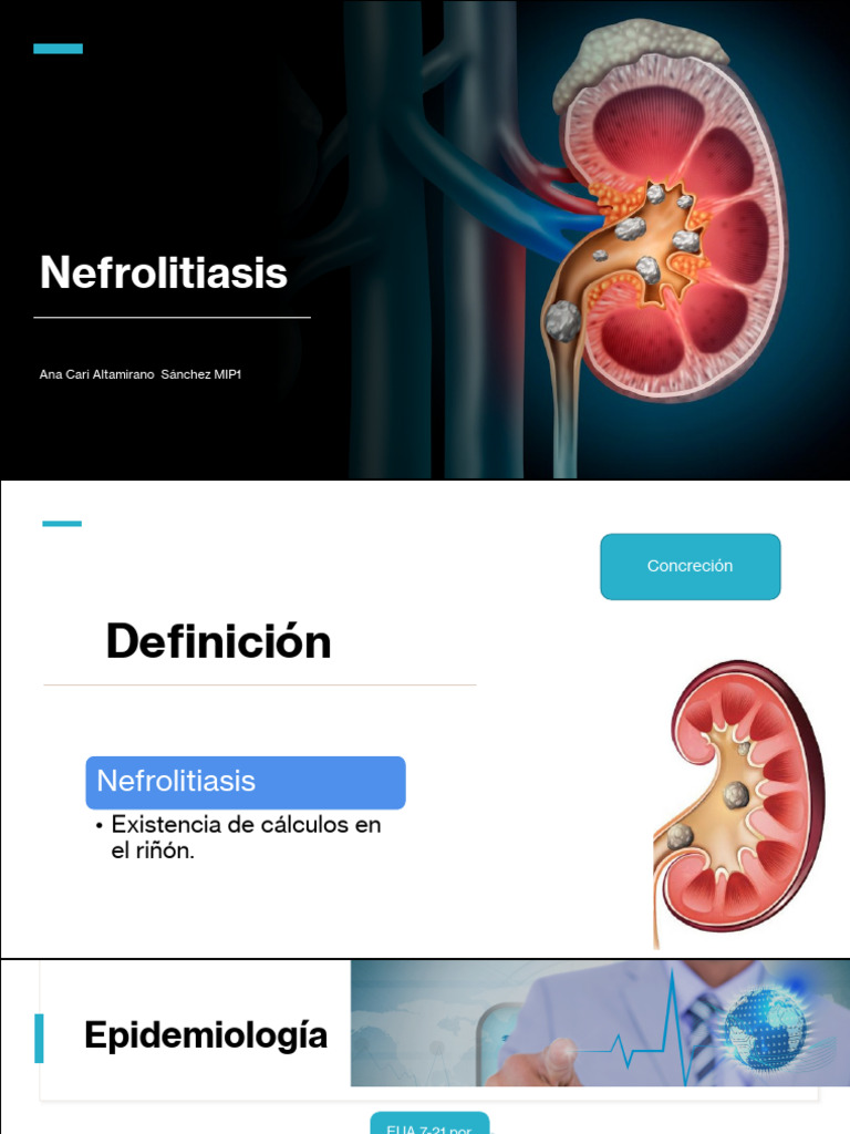 Nefrolitiasis | PDF | Urología | Medicina CLINICA