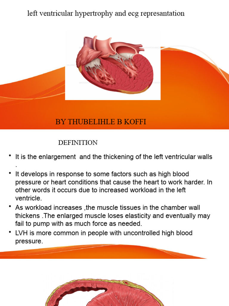 4left Ventricular Hypertrophy And Ecg Represantatio Pdf 5749
