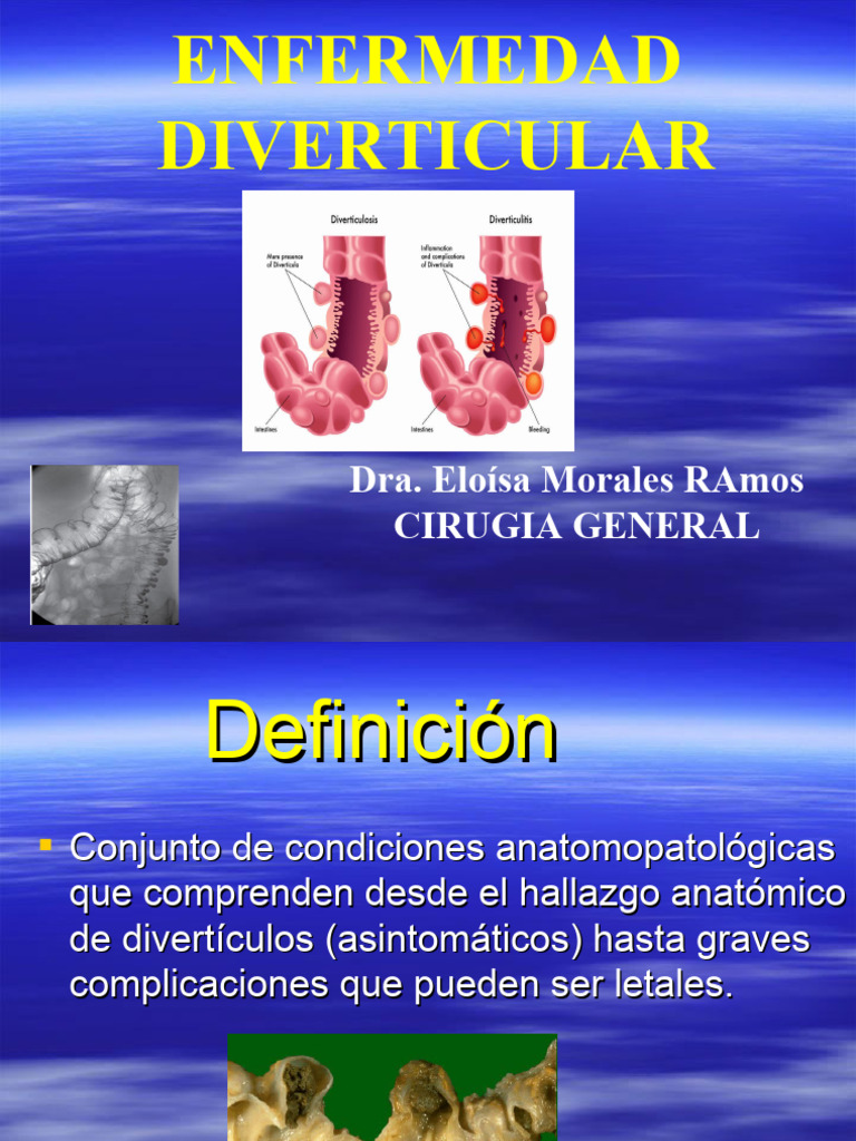 Enfermedad Diverticular 2022 | PDF