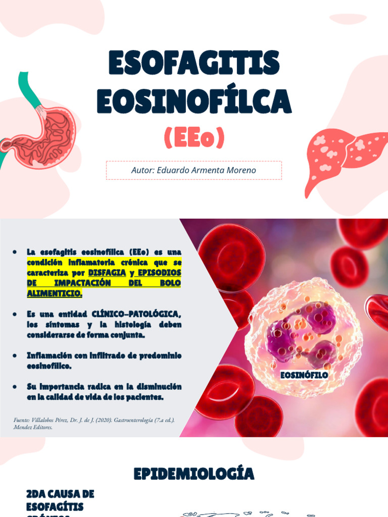 Esofagitis Eosinofílica | PDF | La enfermedad por reflujo ...