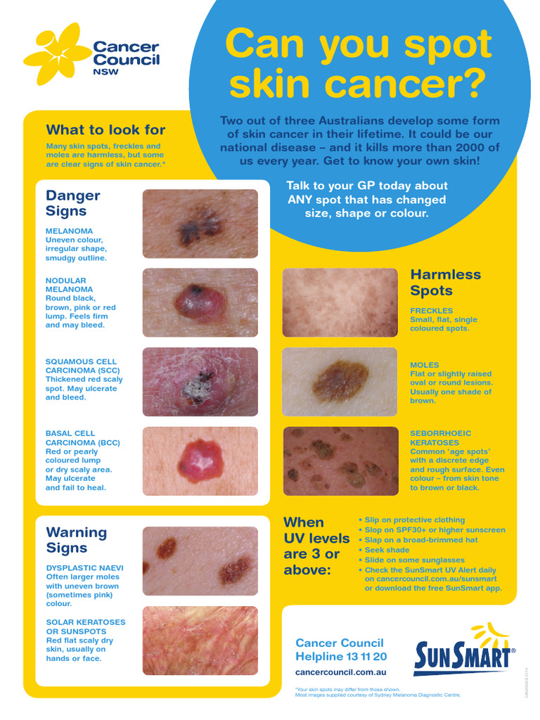 Can You Spot Skin Cancer A3 Poster | PDF | Skin Cancer | Epidemiology
