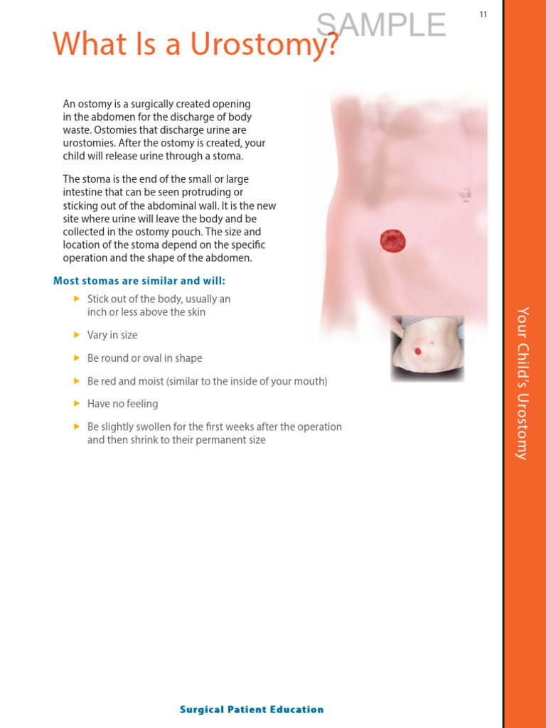 Your Childs Urostomy | PDF | Urinary System | Urine