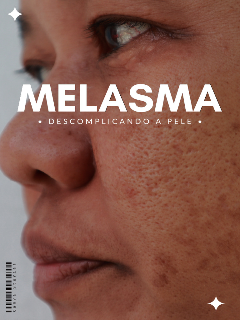 Ebook - Melasma | PDF