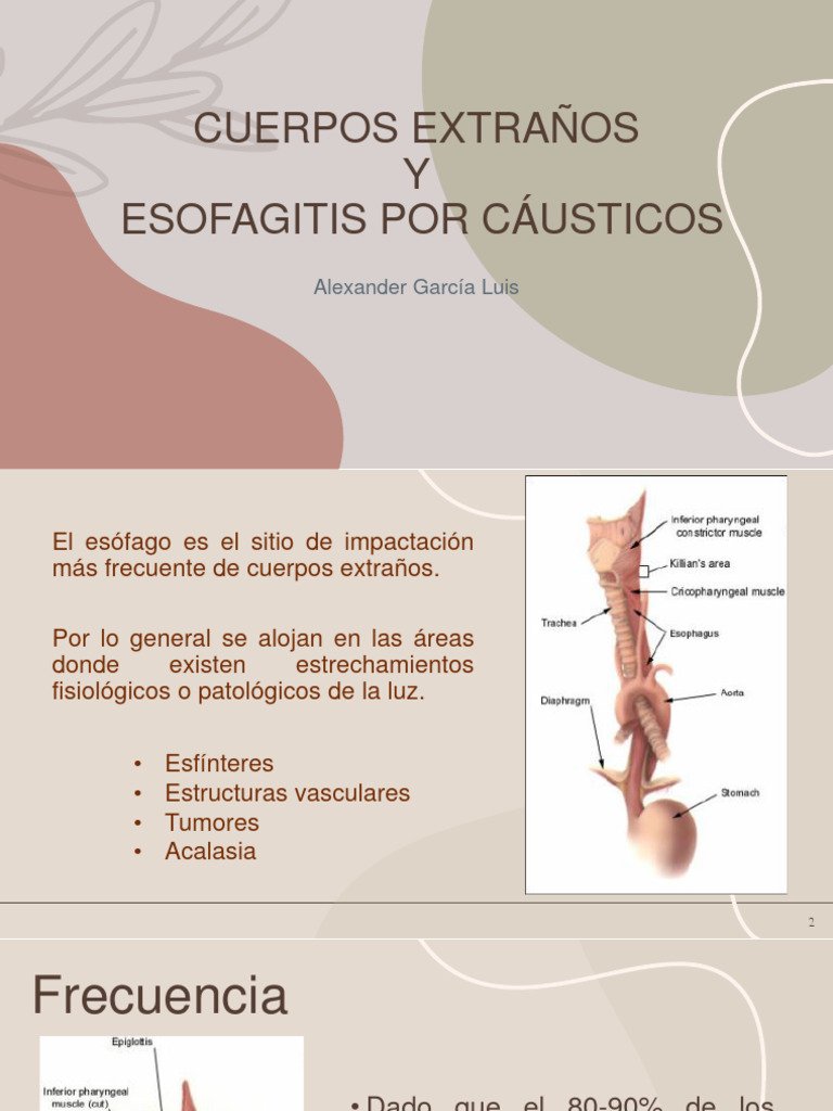 Cuerpos Extraños y Esofagitis Por Cáusticos | PDF | Esófago | Endoscopia