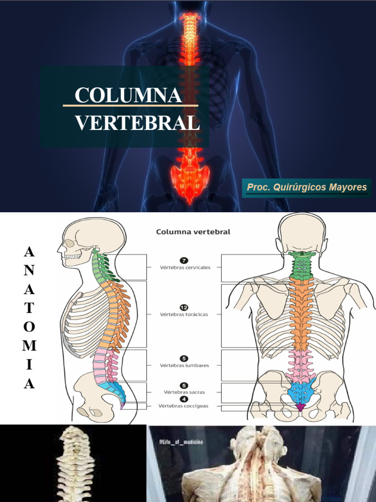 Fracturas y Cirugía de Columna Vertebral | PDF | Sistema esquelético ...