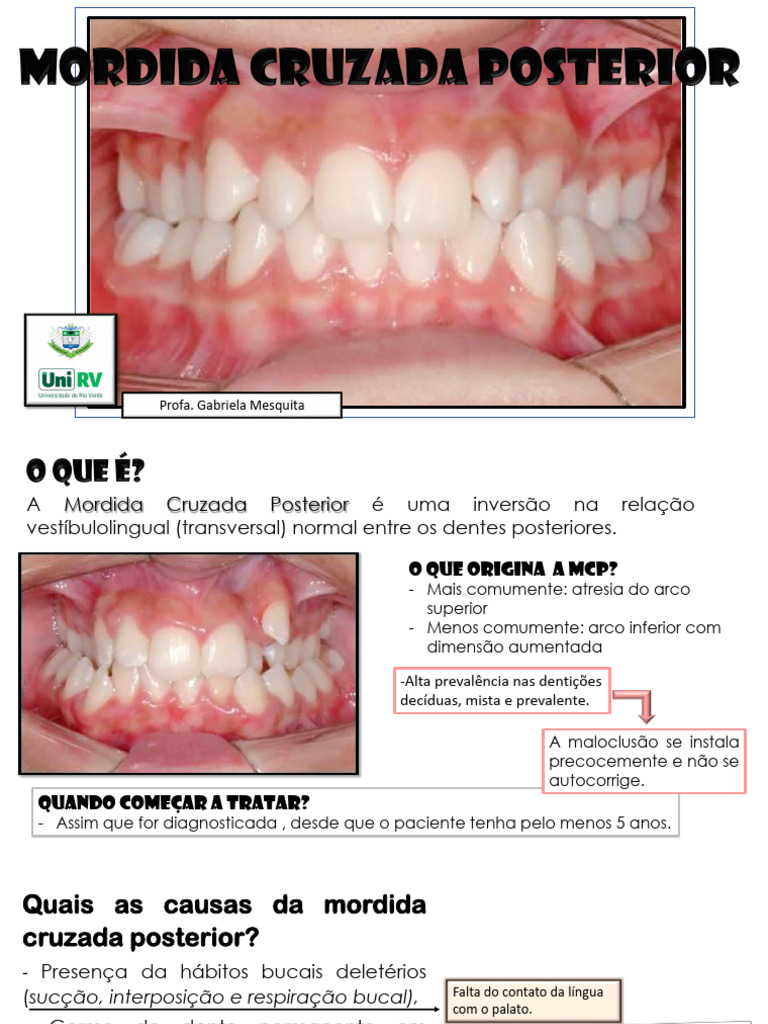 Tratamento da Mordida Cruzada Posterior | PDF | Dente | Boca