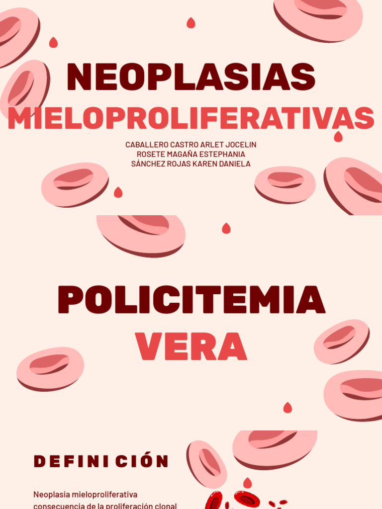 Neoplasias Mieloproliferativas | PDF | Leucemia | Linfocitos