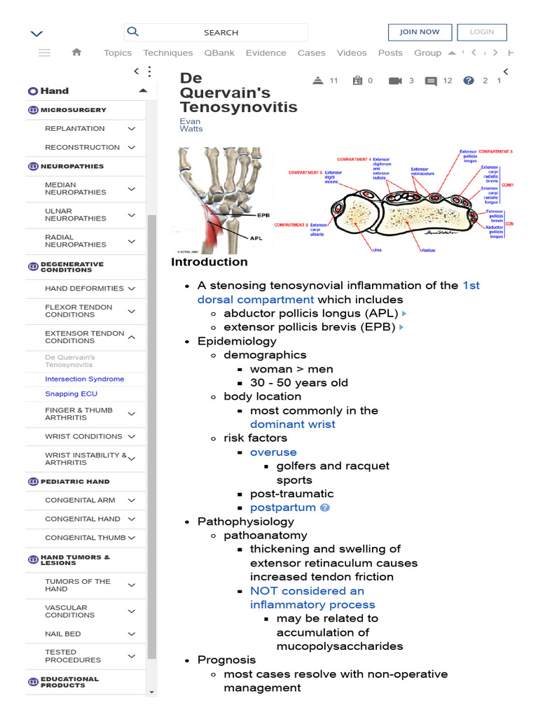 De Quervain's Tenosynovitis - Hand - Orthobullets | PDF | Thumb | Hand