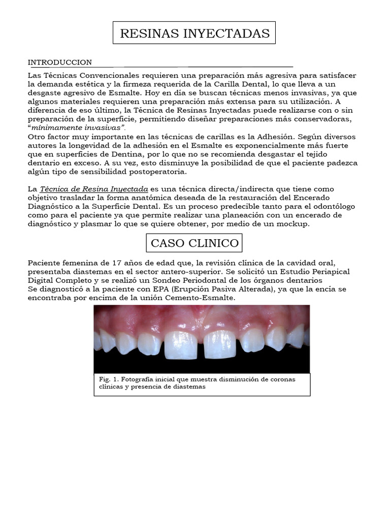 Carillas Inyectadas: Técnica y Ventajas | PDF | Odontología | Ciencias ...