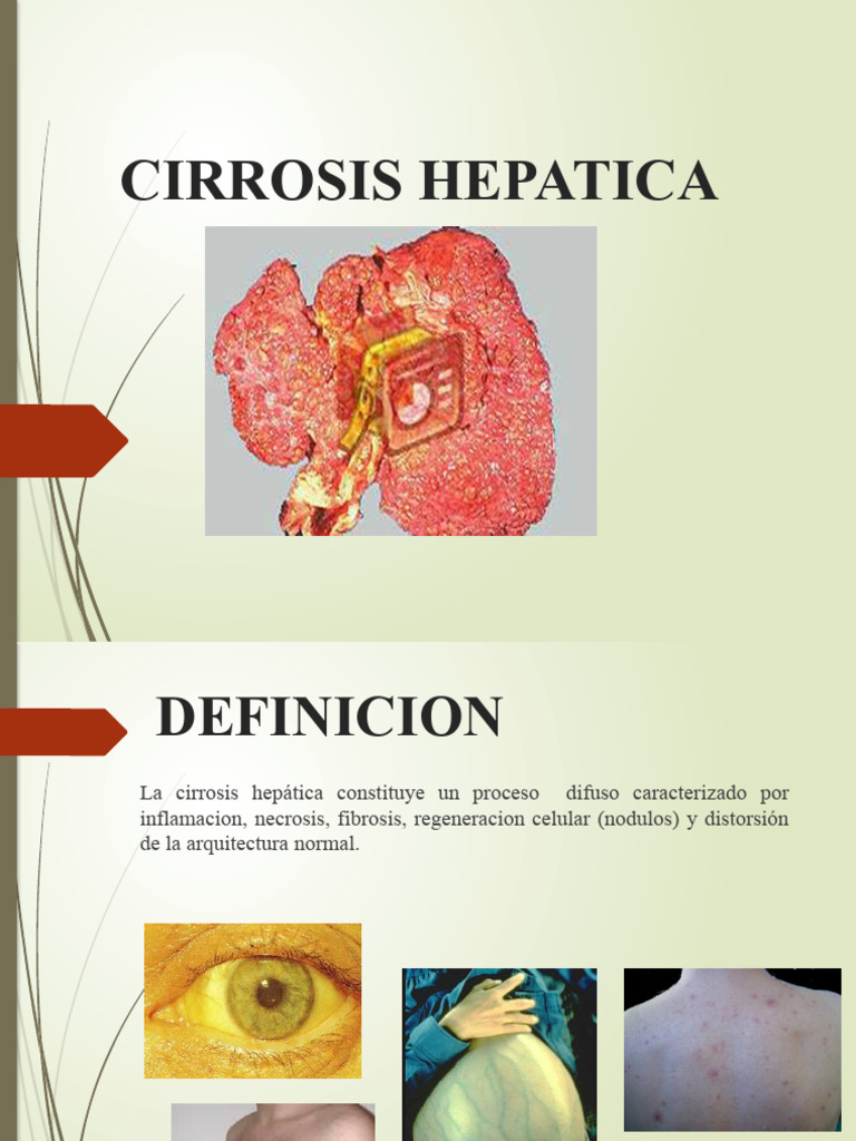 Cirrosis Hepatica | PDF | Hepatitis | Hepatitis B
