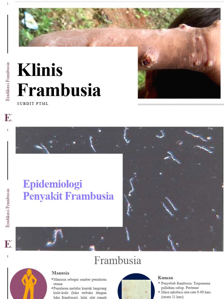 Klinis Frambusia | PDF