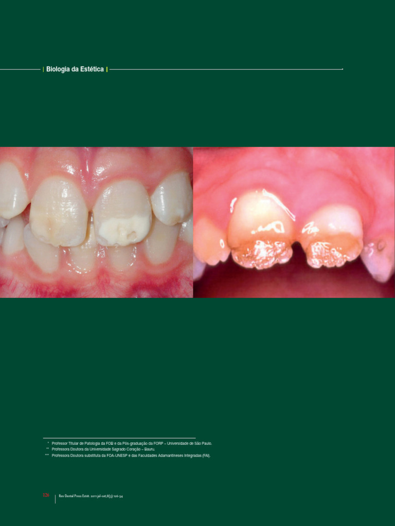 Hipoplasia | PDF | Dente | Esmalte dentário