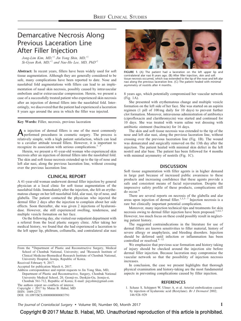 Demarcative Necrosis Along Previous Laceration Line After Filler ...