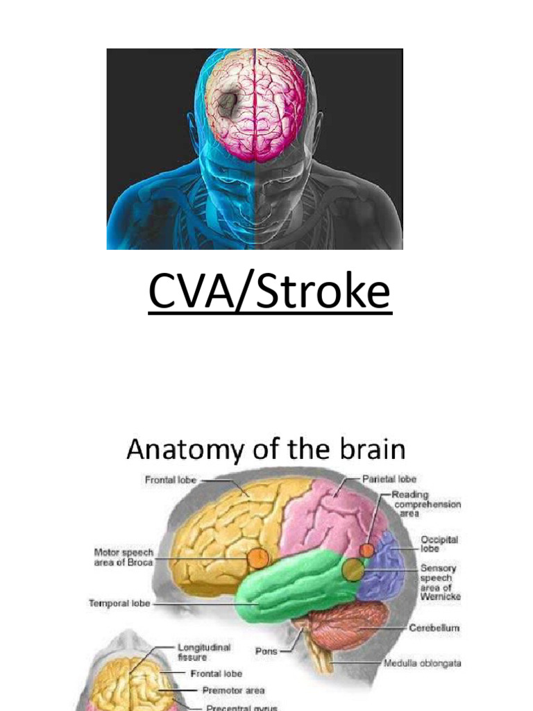 CVA Sushila | PDF | Stroke | Ischemia