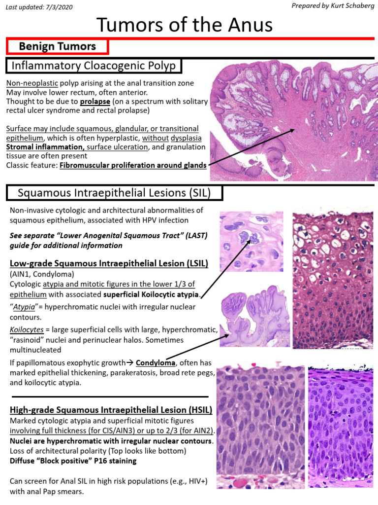 Anal Tumors | Download Free PDF | Epithelium | Carcinoma