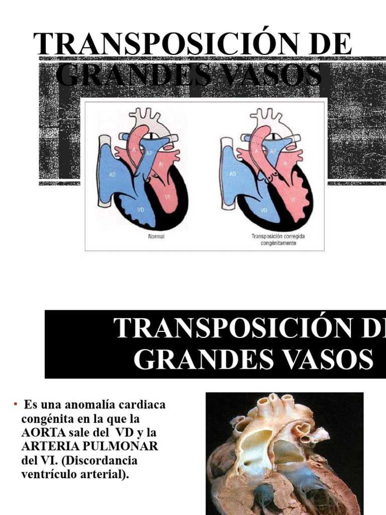 Transposición de Grandes Vasos | PDF | Insuficiencia cardíaca | Hemodinámica