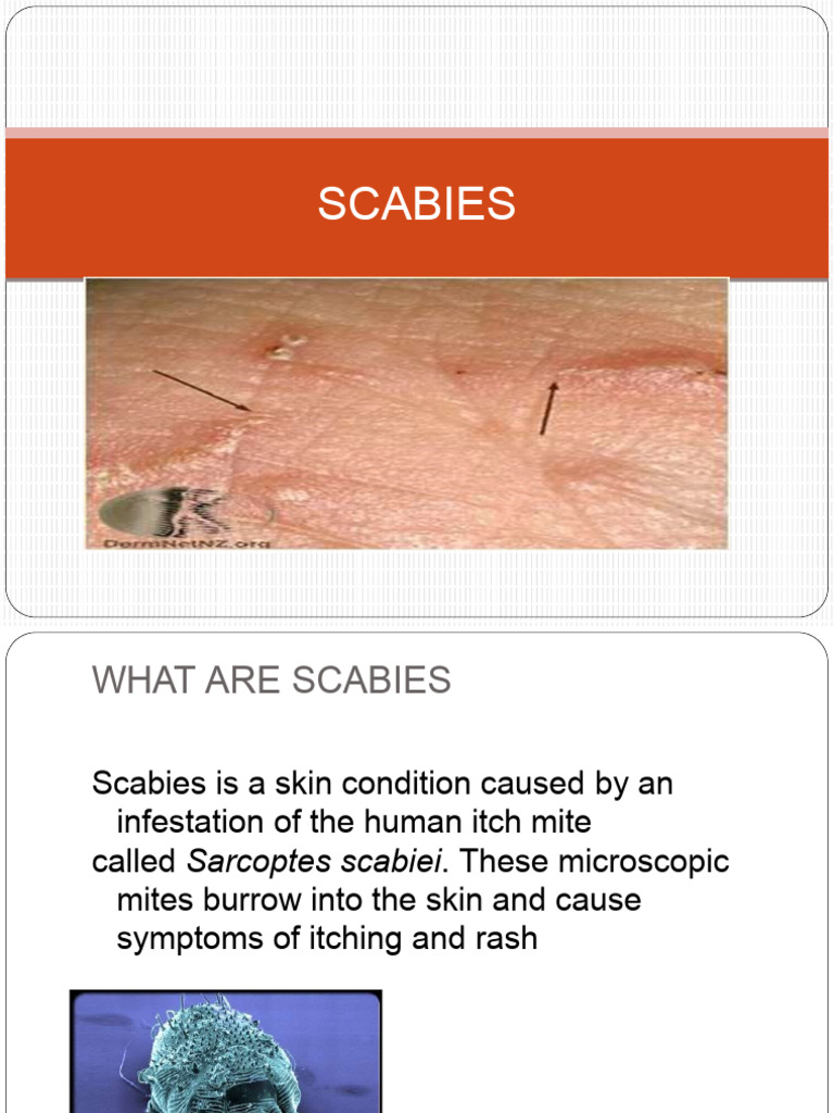 Scabies | PDF | Clinical Medicine | Dermatology