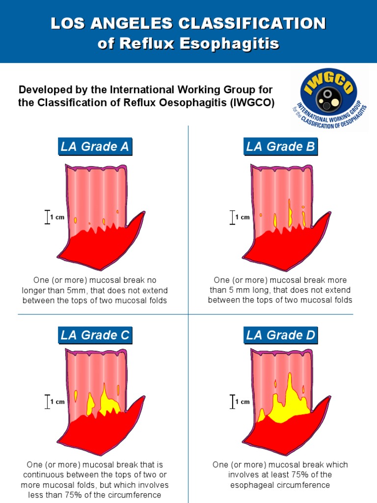 LA Classification Esofagitis | PDF